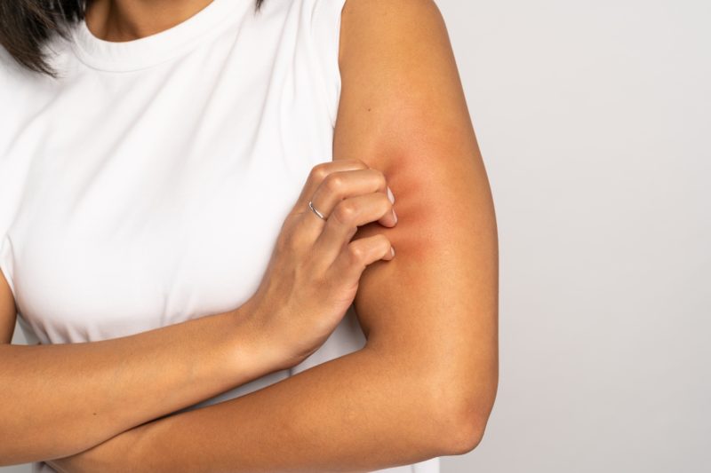 Pinched Nerves & Itching | Upper Cervical Care Draper